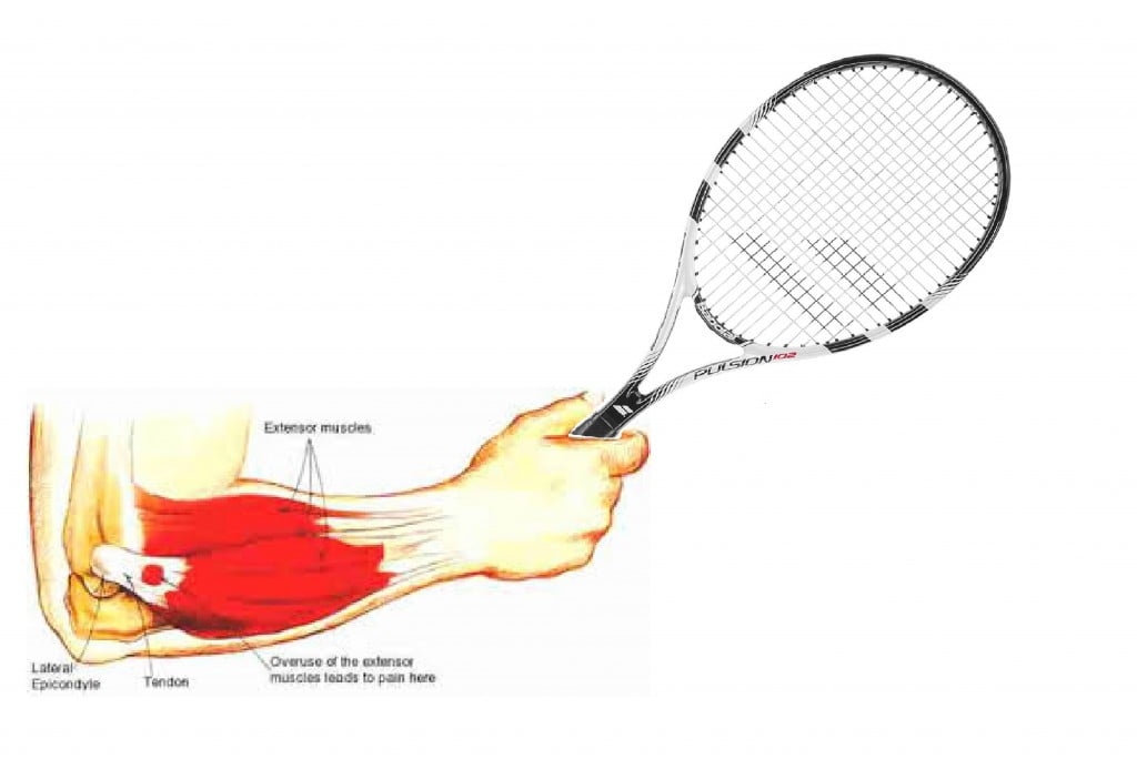 Tennis Elbow Causing You Pain? PRP is NOT the Solution Study Shows ...